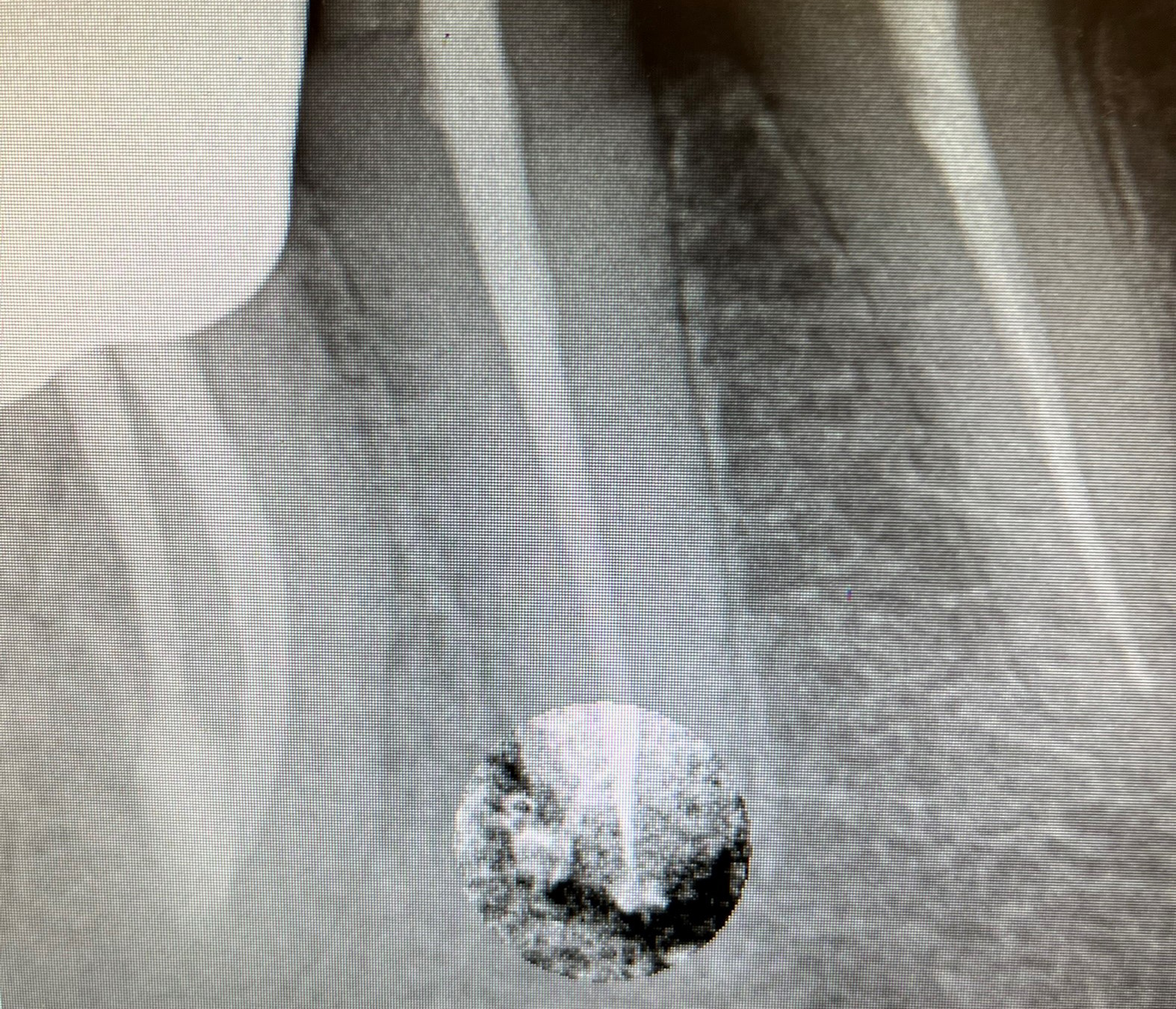 BioRoot Flow: a new root canal sealer in a syringe based on ABS Technology